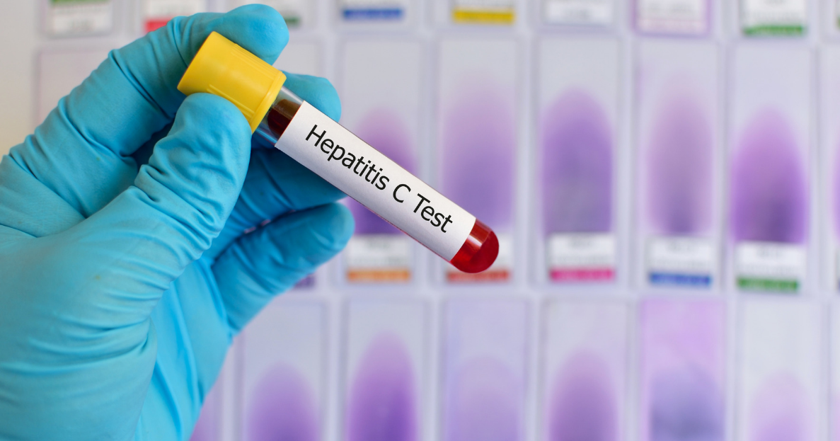 Performance of HCV Antigen Testing for the Diagnosis and Monitoring of ...